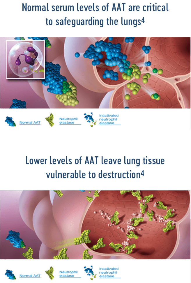 Pathophysiology and pathogenesis of AAT Deficiency | HCP Site
